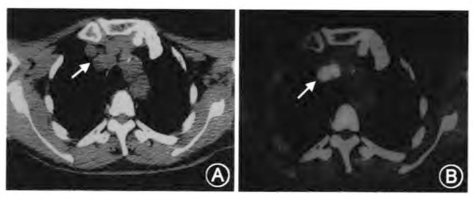 SOX1抗体的诊断学意义 - 海默医学