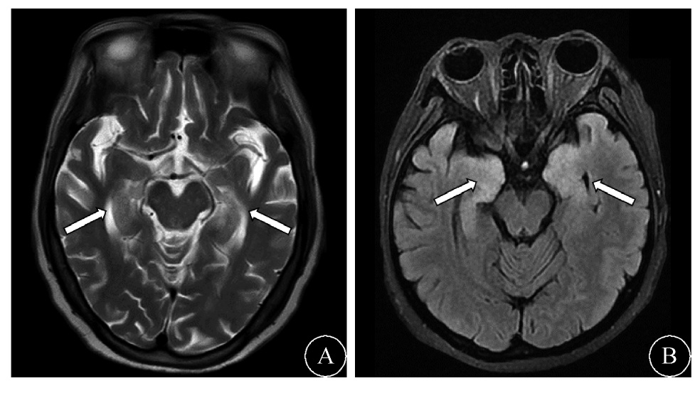 自免脑之抗GABABR抗体相关脑炎 - 海默医学