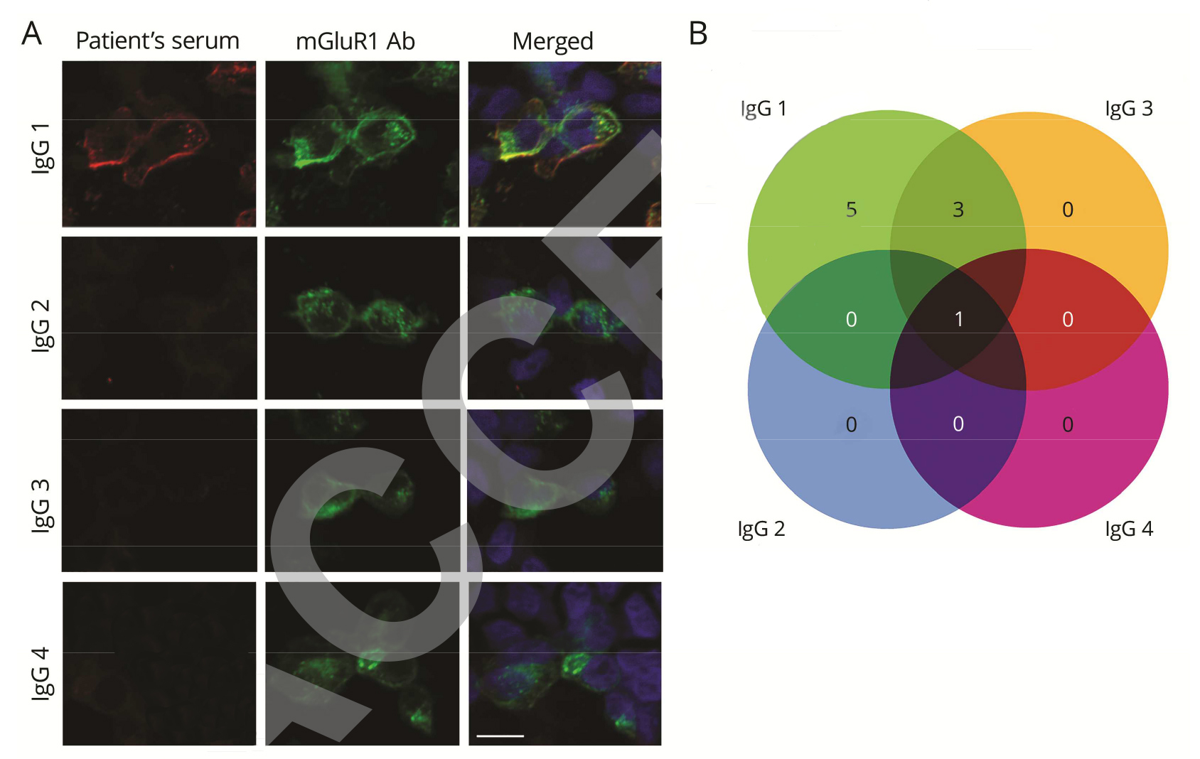 2020年mGluR抗体代谢型谷氨酸受体脑炎特点 - 海默医学