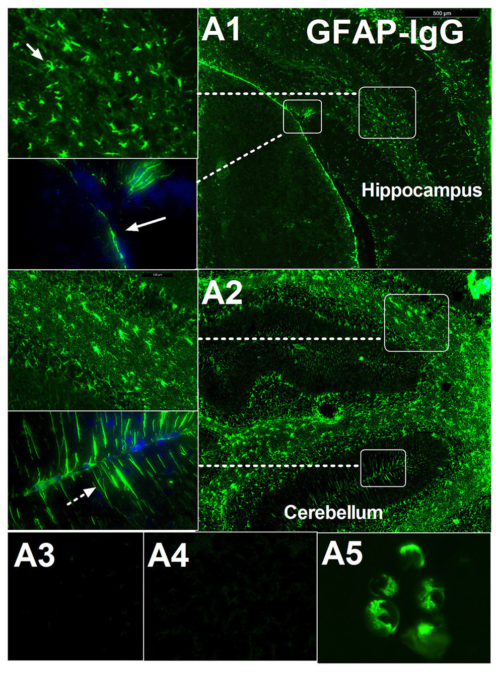 自身免疫性胶质纤维酸性蛋白星形细胞病 - 海默医学