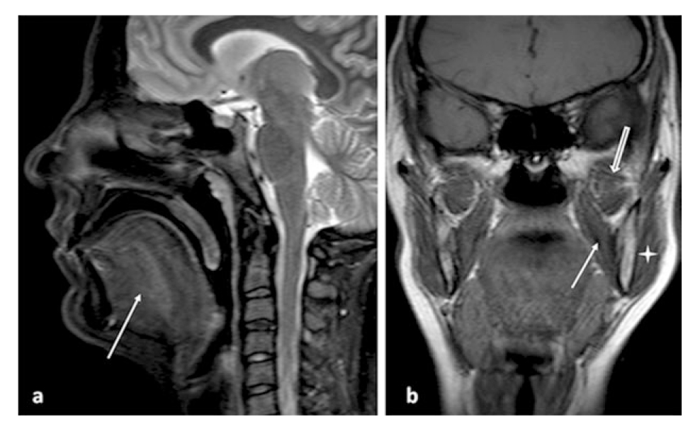AChR和MuSK双重阳性的重症肌无力 - 海默医学