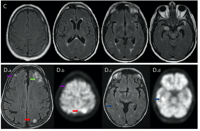 新型脑炎之GABAAR - 海默医学