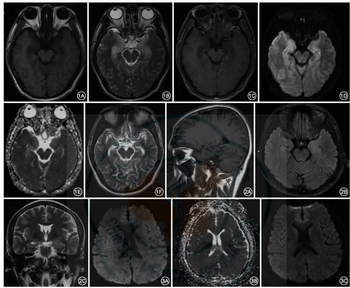 抗GABABR脑炎：临床和实验室特征、影像学检查、诊断、治疗和预后 - 海默医学