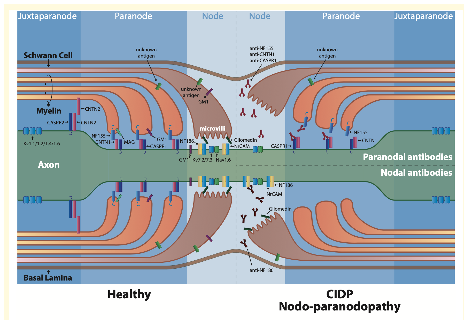 CIDP的自身抗体检测 - 海默医学
